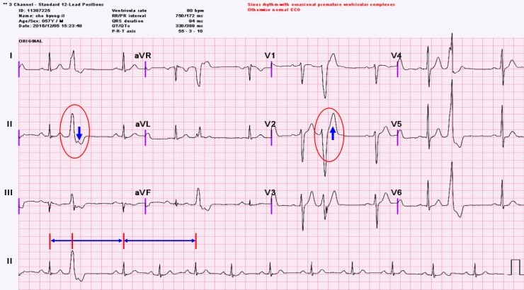 심장리듬 III. 조기박동, 기외수축 : 네이버 블로그