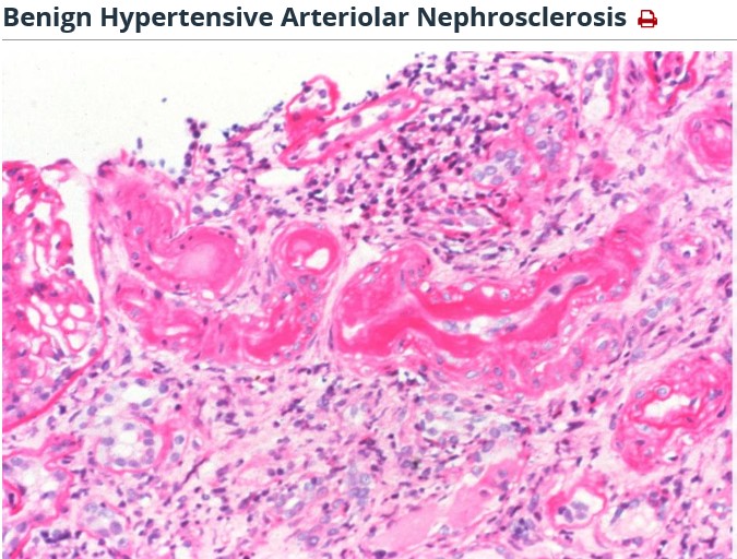 benign hypertensive arteriolar nephrosclerosis (hypertensive kidney ...