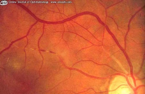hypertensive retinopathy(고혈압 망막병증) : 네이버 블로그