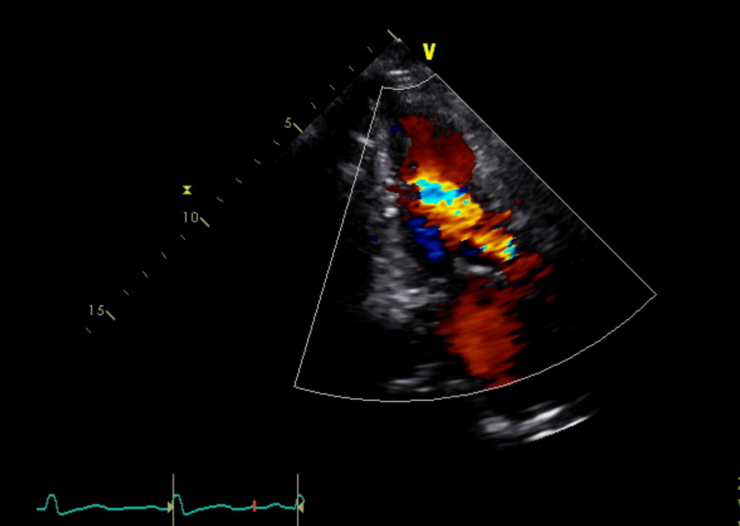 Aortic regurgitation -> Qualitative assessment (2-1) : 네이버 블로그