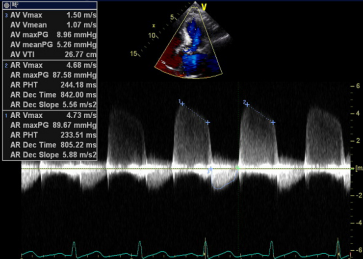 Aortic regurgitation -> Qualitative assessment (2-1) : 네이버 블로그