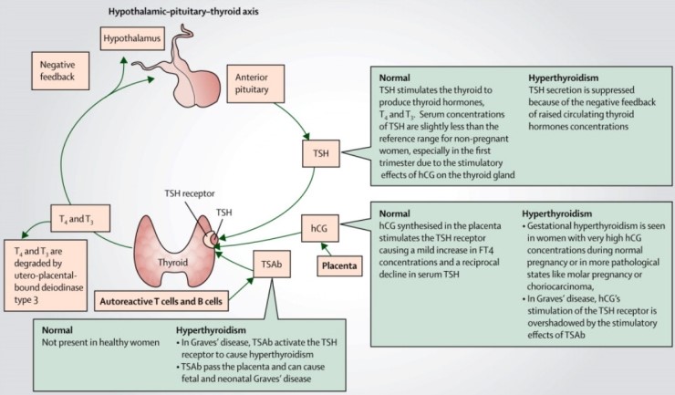 hyperthyroidism in pregnancy(임신 중 갑상선항진증) : 네이버 블로그