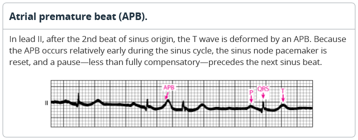 Ectopic supraventricular rhythms : 네이버 블로그