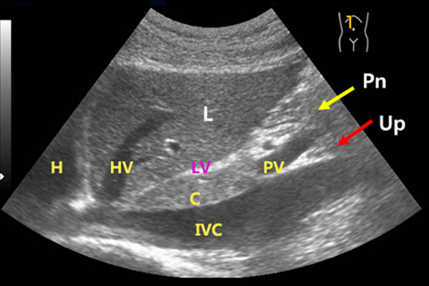 췌장 종단면 초음파 관찰 : 네이버 블로그