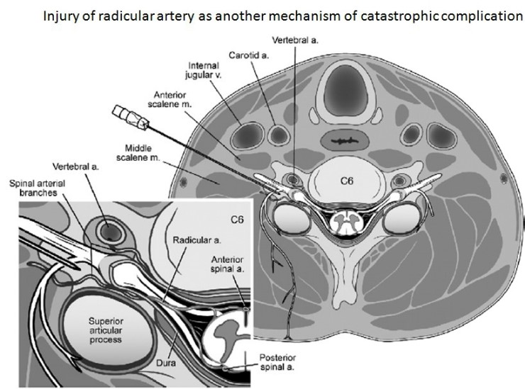 interscalene brachial plexus block 합병증 및 시술주의 사항 : 네이버 블로그