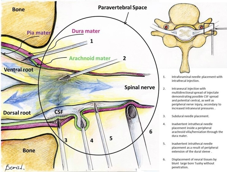 interscalene brachial plexus block 합병증 및 시술주의 사항 : 네이버 블로그