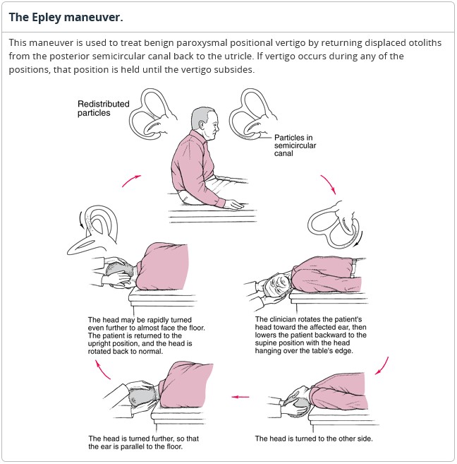 benign paroxysmal postional vertigo(BPPV, 양성체위성 돌발현훈, 이석증) : 네이버 블로그