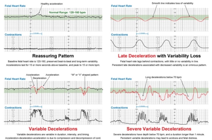 fetal heart rate during labor / cardiotocography (CTG) : 네이버 블로그
