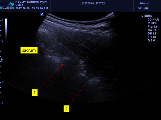 요추의 신경 차단술 (psoas compartment block), L4~5 root block (김천 통증의학과, 통증의원 ...