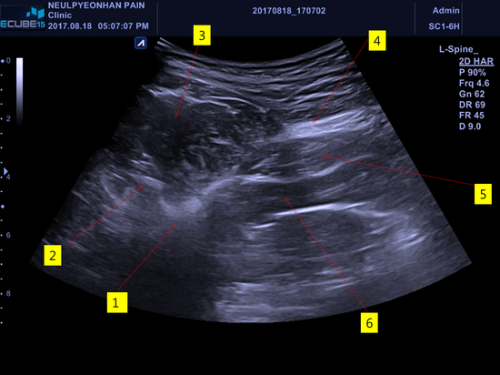 요추의 신경 차단술 (psoas compartment block), L4~5 root block (김천 통증의학과, 통증의원 ...