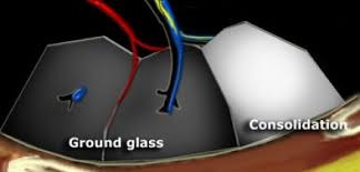 GGO(Ground Glass Opacity) vs Consolidation : 네이버 블로그