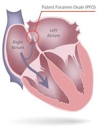 ASD vs PFO : 네이버 블로그