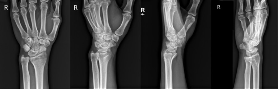 Wrist series : 네이버 블로그