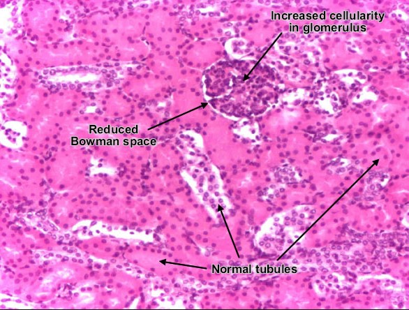 poststreptococcal glomerulonephritis(PSGN, 사슬알균 감염후 토리콩팥염) : 네이버 블로그