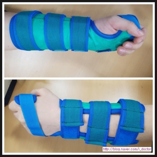 뉴프리몰드스프린트~~(New Pre-Mold Splnt) : 네이버 블로그