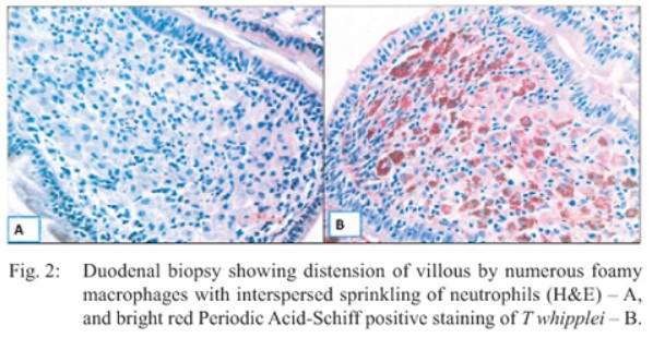 Whipple disease : 네이버 블로그
