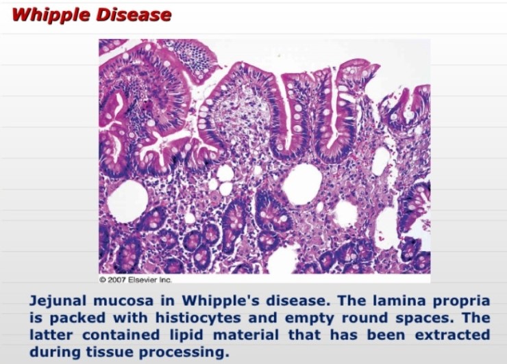 Whipple disease : 네이버 블로그