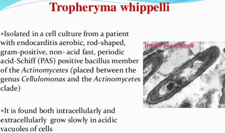 Whipple disease : 네이버 블로그