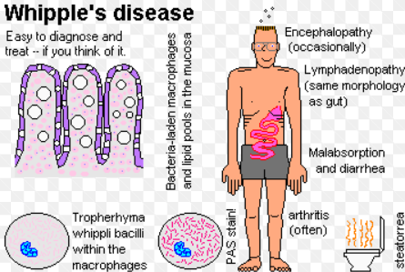 Whipple disease : 네이버 블로그