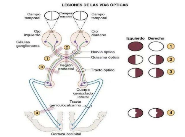 middle cerebral artery syndrome : stroke of MCA : 네이버 블로그