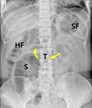 대장내시경 삽입의 실제 - 구불결장, SDJ, 하행결장 : 네이버 블로그