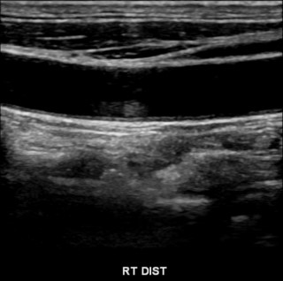 경동맥 초음파검사의 실제 : 네이버 블로그