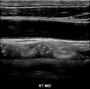 경동맥 초음파검사의 실제 : 네이버 블로그