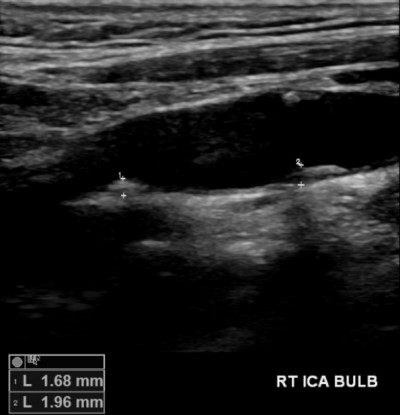 경동맥 초음파검사의 실제 : 네이버 블로그