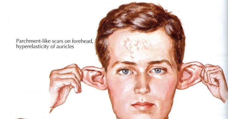 Ehlers-Danlos syndrome (엘러스 단로스 증후군) : 네이버 블로그