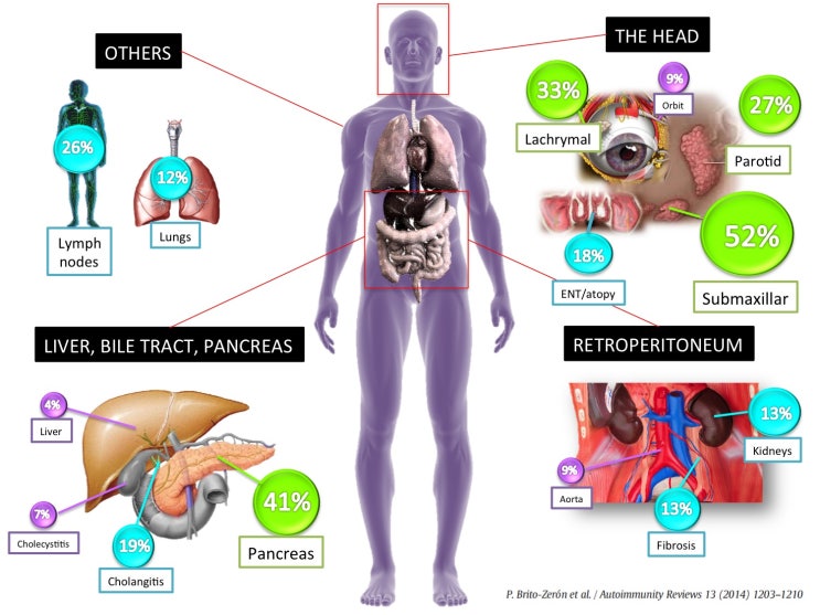 IgG4 연관질환(IgG4-RD) 원인, 증상, 진단검사와 치료 : 네이버 블로그