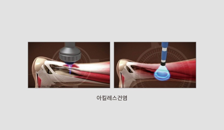 중고판매완료 체외 충격파 치료기 Dual Wave Plus 네이버 블로그