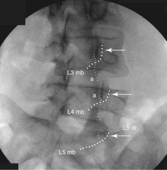 Lumbar(요추) Medial Branch Block(MBB) (C-arm)_ 술기와 용량 : 네이버 블로그
