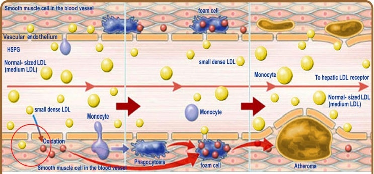 sdLDL =Small Dense LDL (저밀도 지단백) : 네이버 블로그