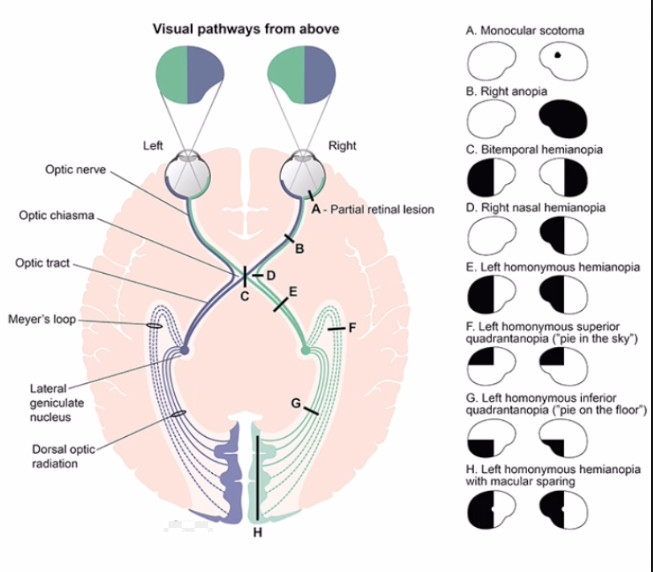 brain lesion and visual field defect : 네이버 블로그