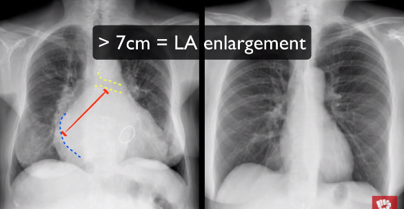 좌심방 확장(Left atrium enlargement): Double density sign(double contour ...
