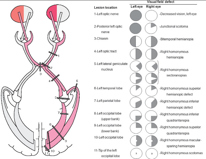 brain lesion and visual field defect : 네이버 블로그