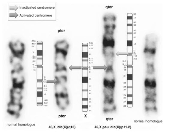 가성 동종 이중심절 X염색체, psu idic(X) : 네이버 블로그