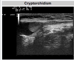 cryptorchidism(잠복고환증) : 네이버 블로그