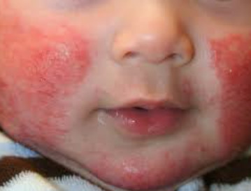 atopic dermatitis / atopy / eczema : 네이버 블로그