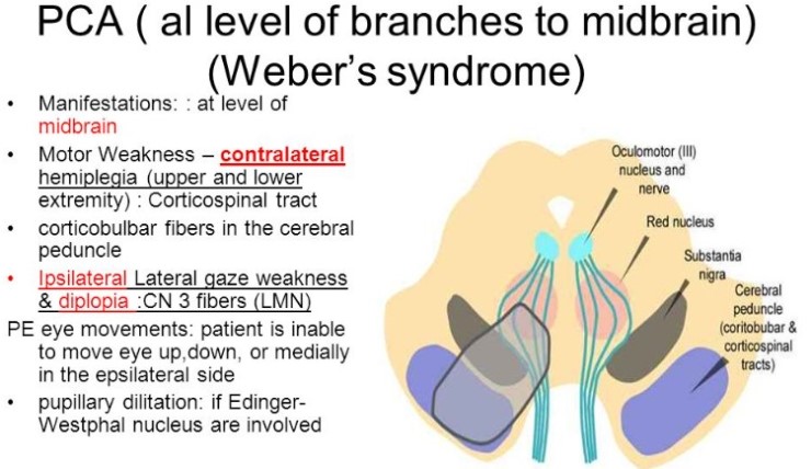 Weber syndrome (superior alternating hemiplegia) : 네이버 블로그