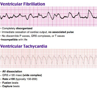 ventricular tachycardia(심실빈맥) : 네이버 블로그