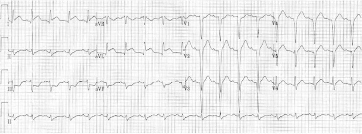 Lateral myocardial infarction : 네이버 블로그