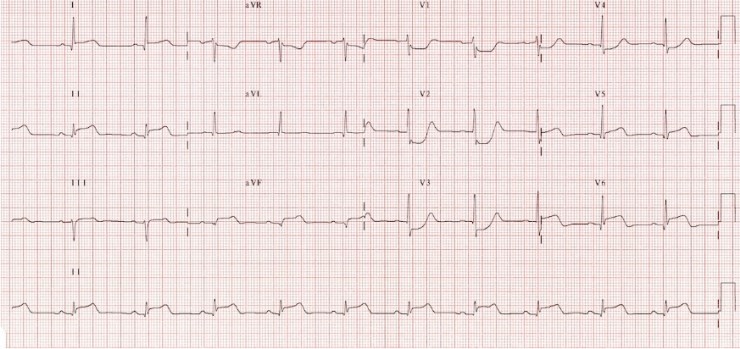Lateral myocardial infarction : 네이버 블로그