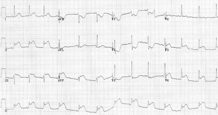 Lateral myocardial infarction : 네이버 블로그