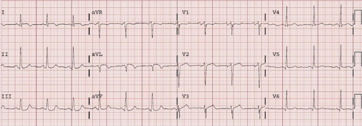 Lateral myocardial infarction : 네이버 블로그