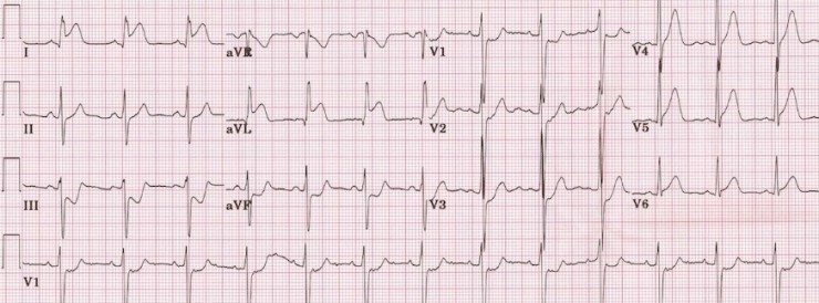 Lateral myocardial infarction : 네이버 블로그