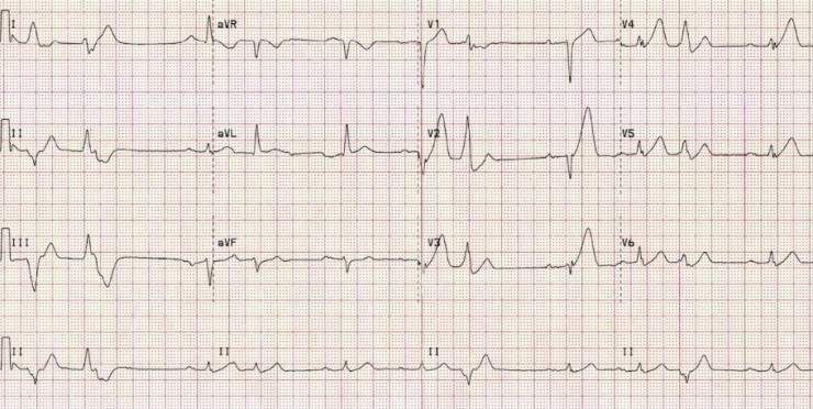 anterior/septal myocardial infarction : 네이버 블로그