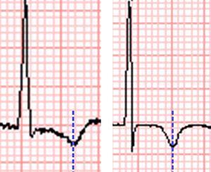 비정상 T파 : tall T & inverted T wave : 네이버 블로그