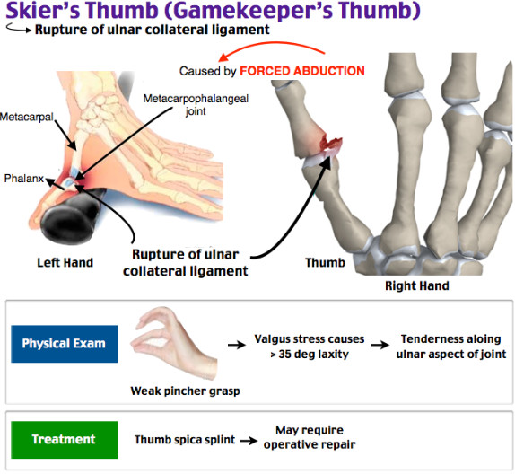 ulnar collateral ligament injury of the thumb (gamekeeper's thumb ...