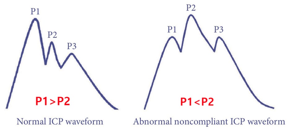 IICP(increased ICP) : 네이버 블로그